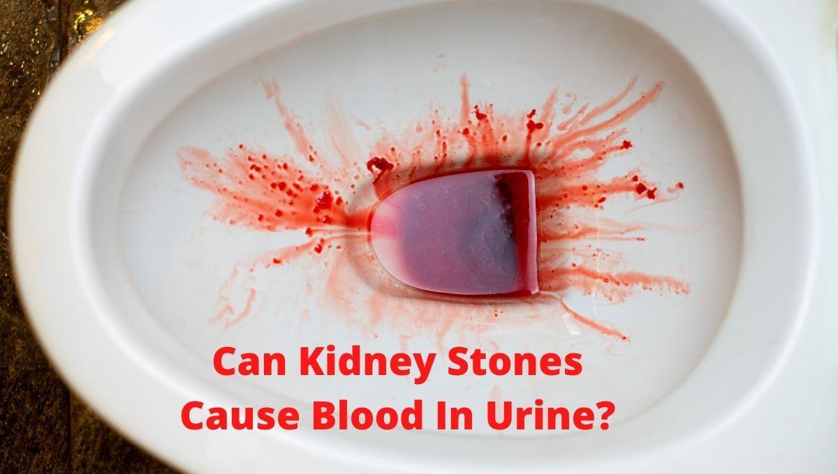 Signs & Symptoms Of Kidney Stones Everyone Needs To Know