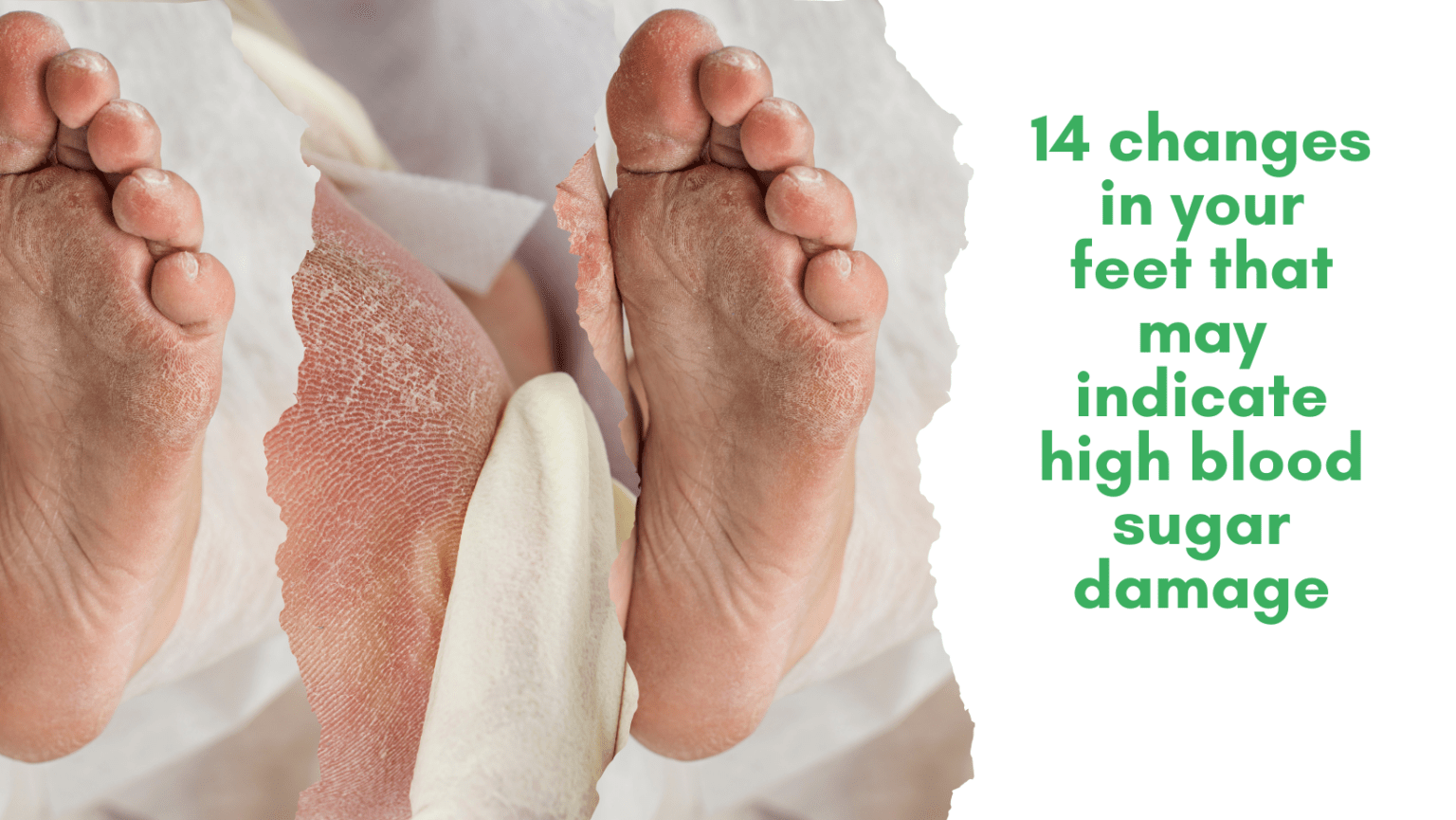 Prevent Diabetic Foot Ulcers By Knowing These Warning Signs